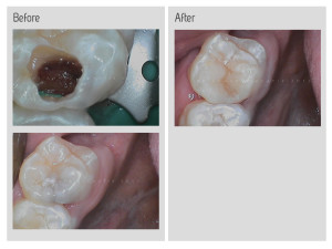 Case Study: Large and Deep Tooth Decay